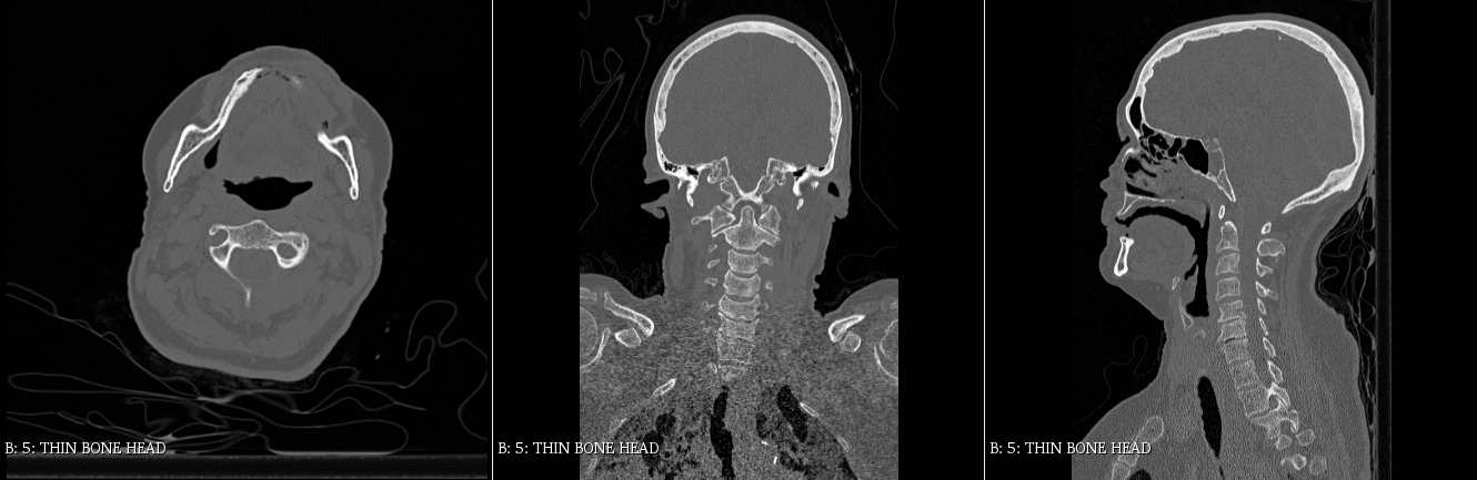 3D Image Acquisition using Medical Images - Skeleton·ID